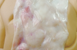 SURGITECHSurgiTech-EGReDura